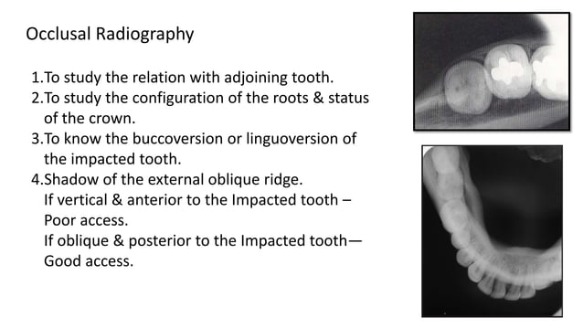 Impaction preoperative assessment.pptx | Dental Health | Diseases and ...