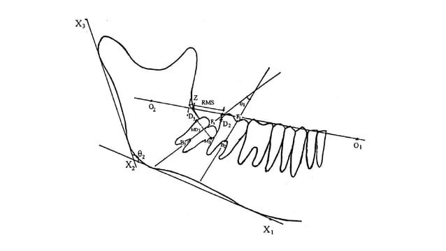 Impaction preoperative assessment.pptx | Dental Health | Diseases and ...