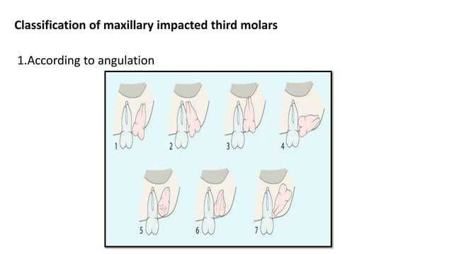 Impaction preoperative assessment.pptx | Dental Health | Diseases and ...