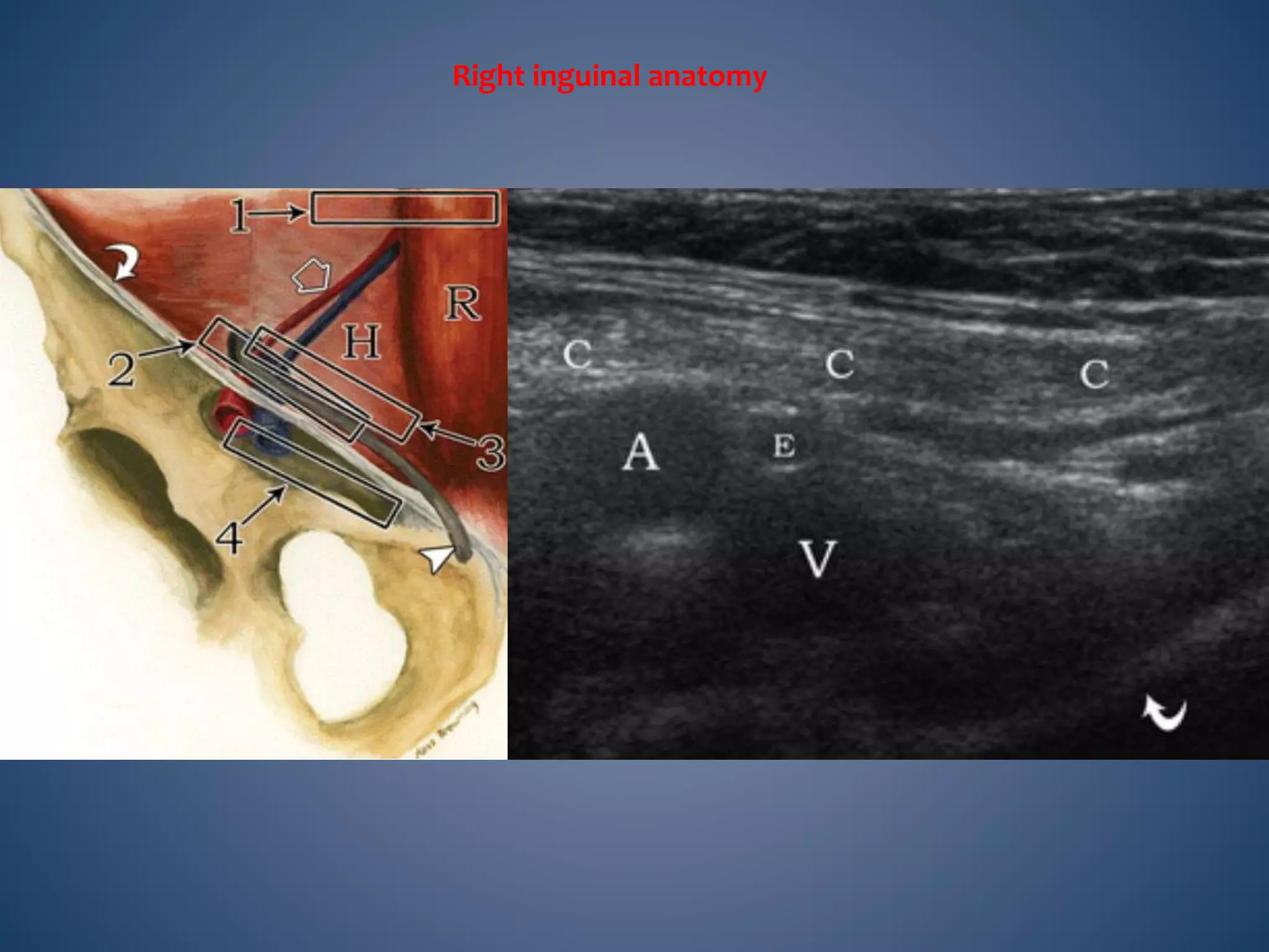 Imaging of Inguino scrotal region | PPTX