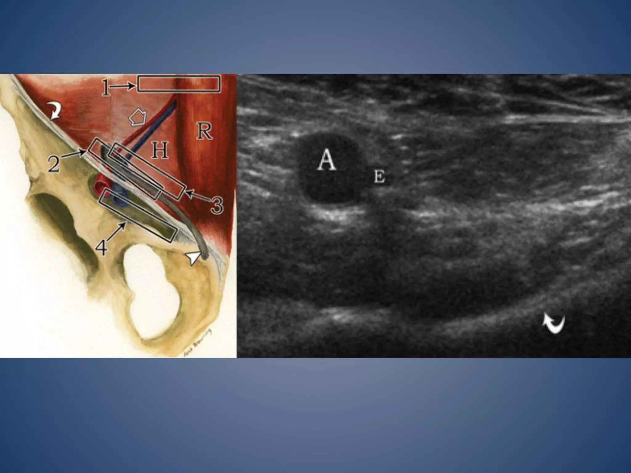 Imaging of Inguino scrotal region | PPTX