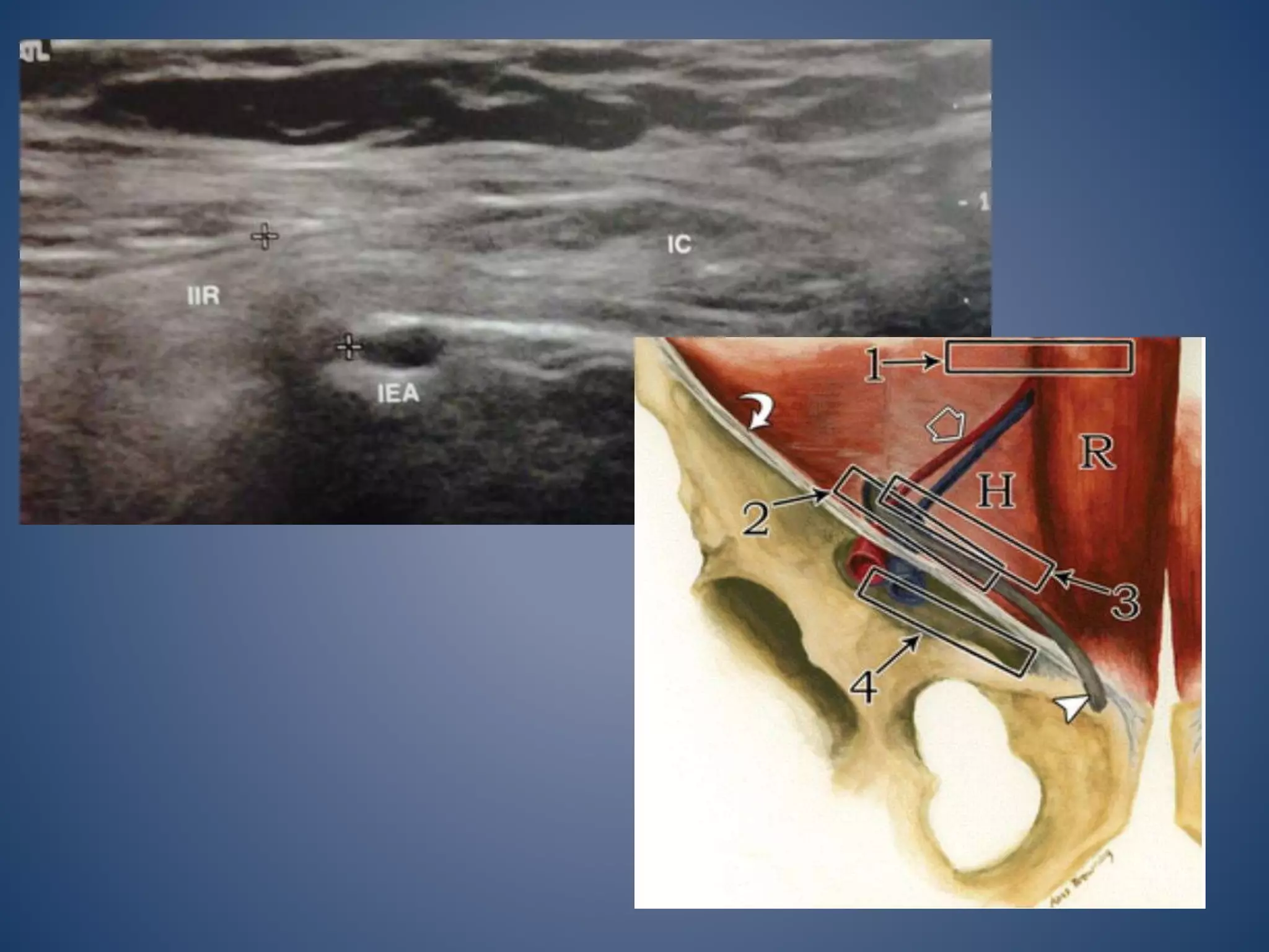 Imaging of Inguino scrotal region | PPTX