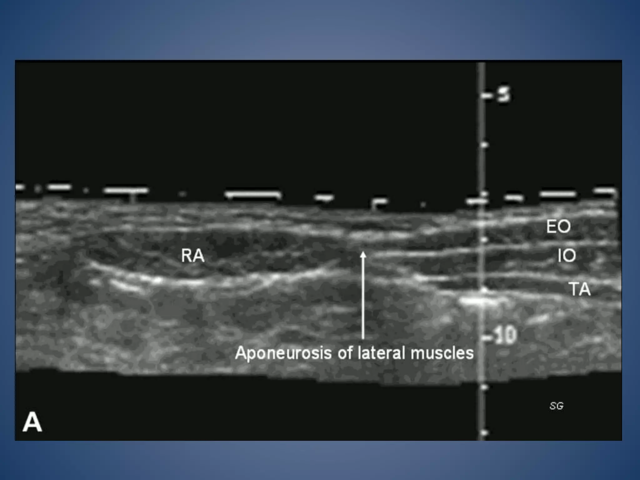 Imaging of Inguino scrotal region | PPTX