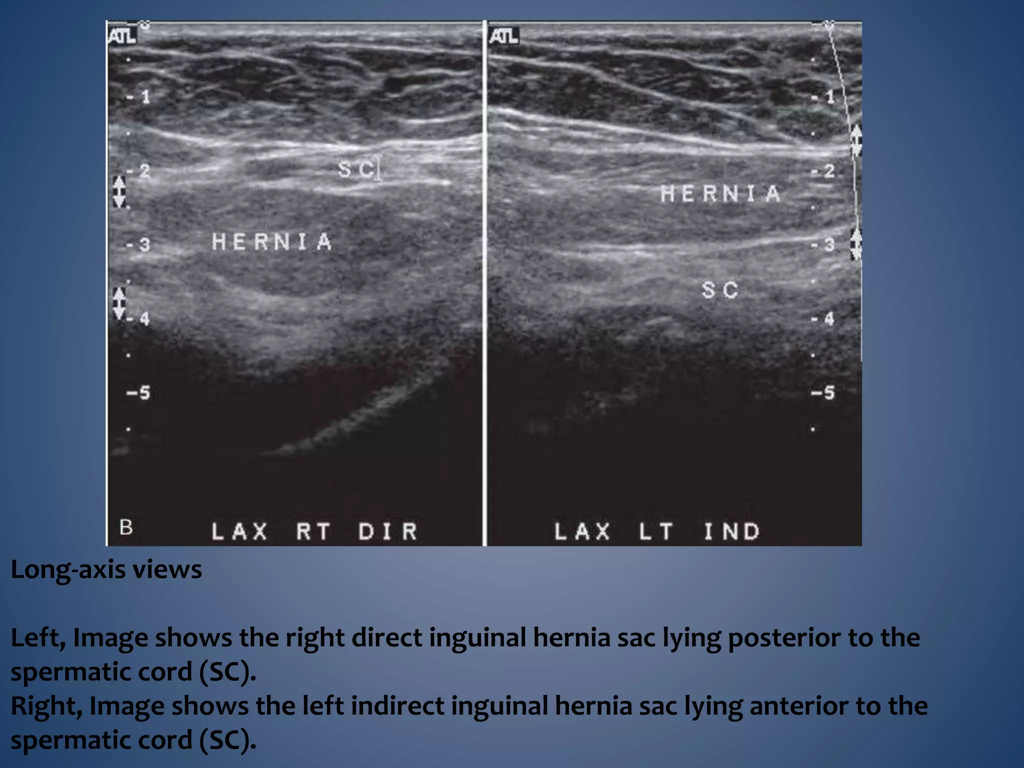 Imaging of Inguino scrotal region | PPTX