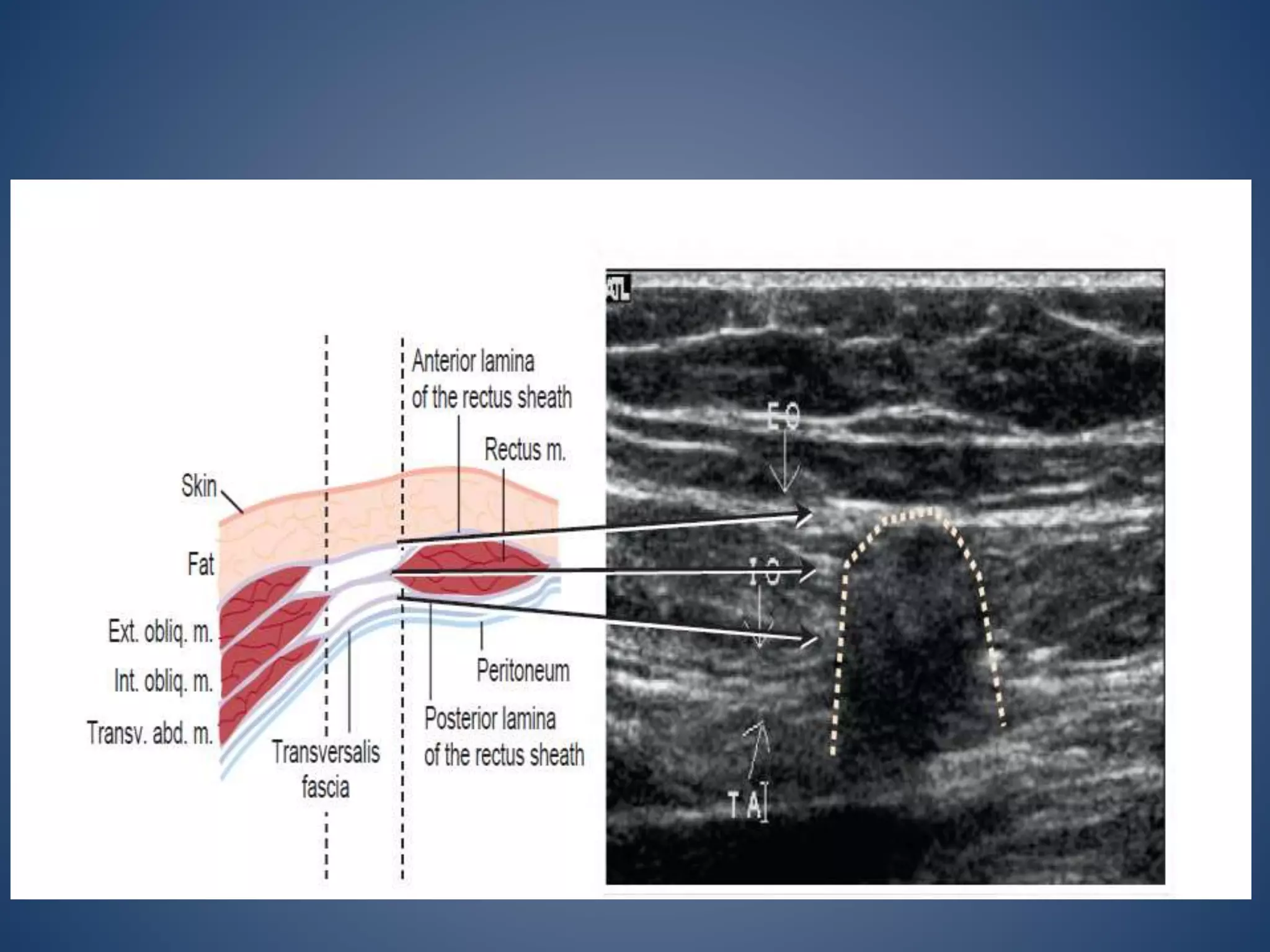 Imaging of Inguino scrotal region | PPTX