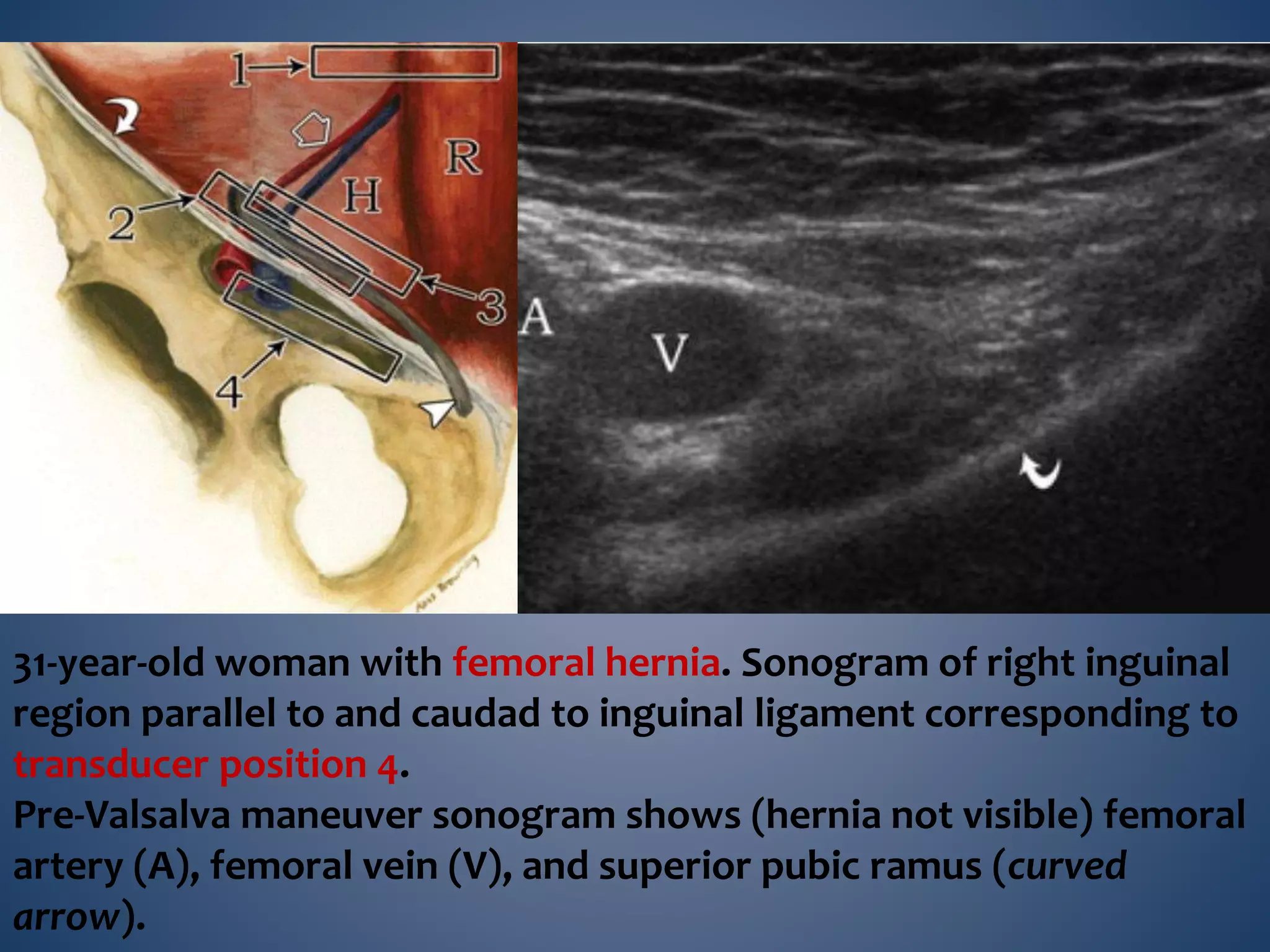 Imaging of Inguino scrotal region | PPTX