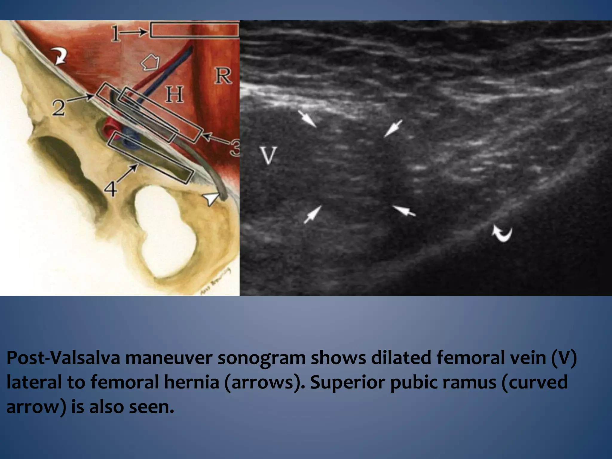 Imaging of Inguino scrotal region | PPTX