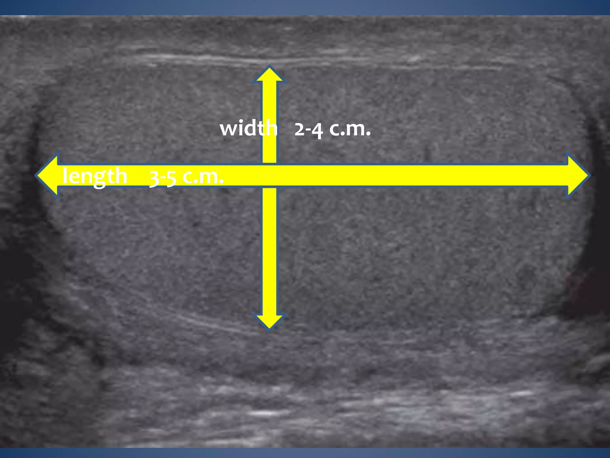 Imaging of Inguino scrotal region | PPTX