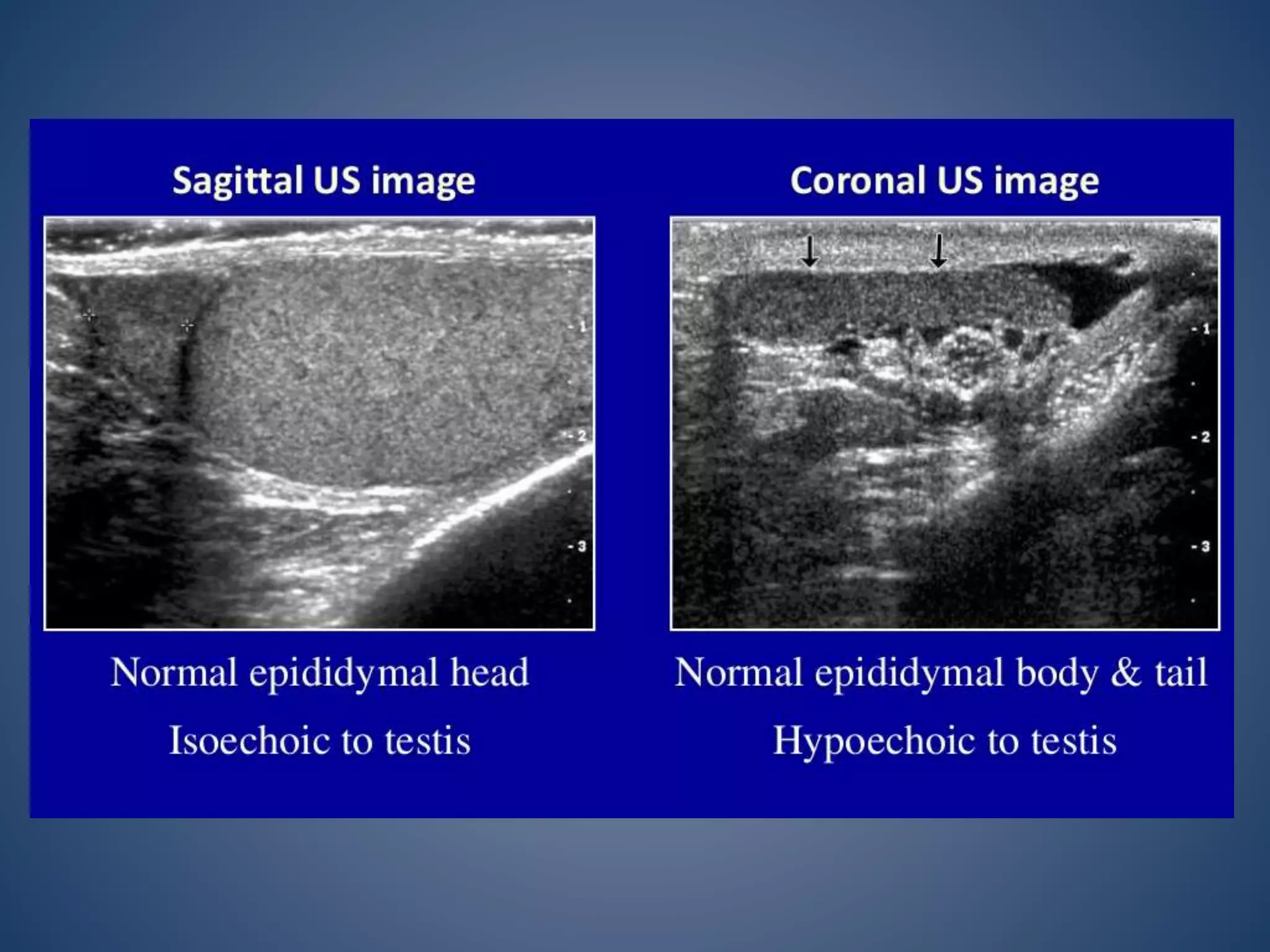 Imaging of Inguino scrotal region | PPTX