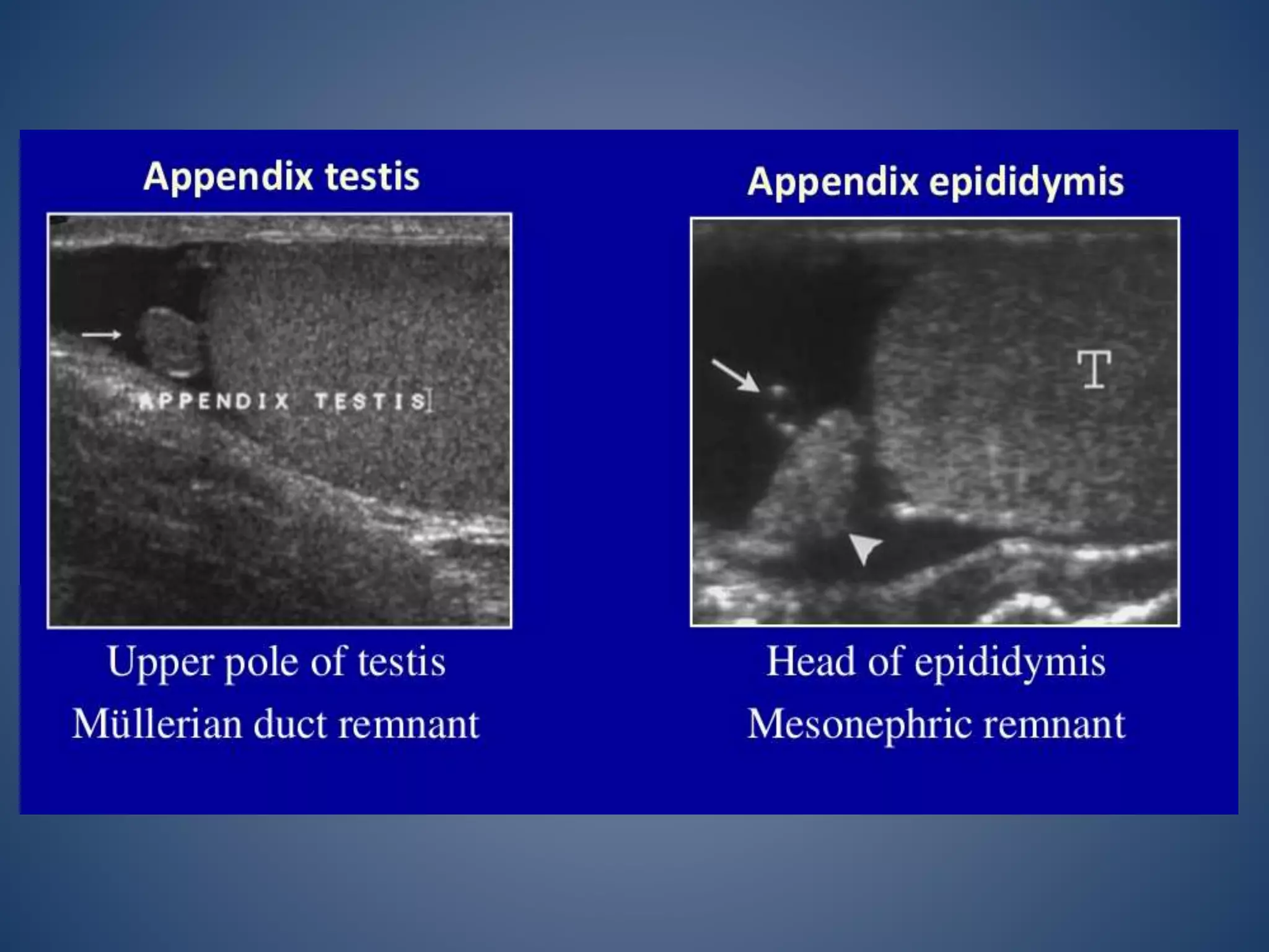 Imaging of Inguino scrotal region | PPTX