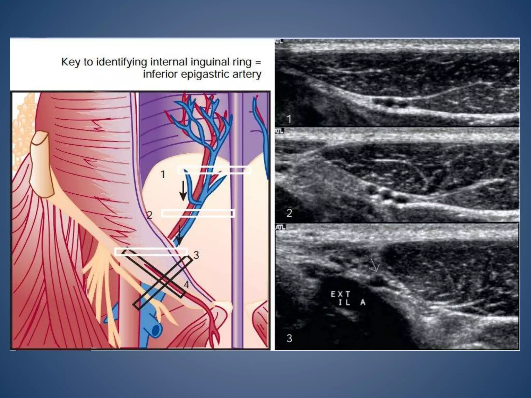 Imaging of Inguino scrotal region | PPTX
