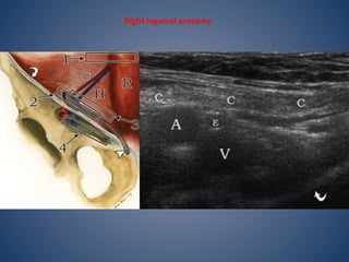Imaging of Inguino scrotal region | PPTX