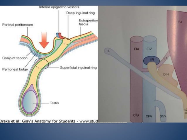 Imaging of Inguino scrotal region | PPTX