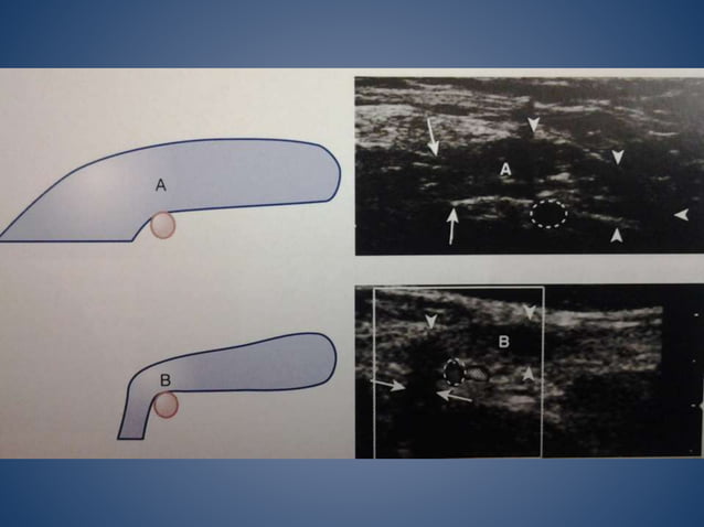 Imaging of Inguino scrotal region | PPTX