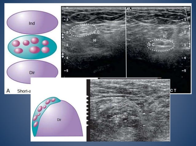Imaging of Inguino scrotal region | PPTX