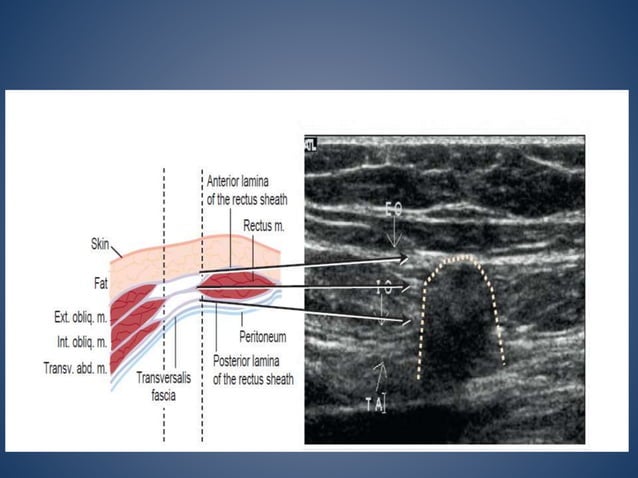 Imaging of Inguino scrotal region | PPTX