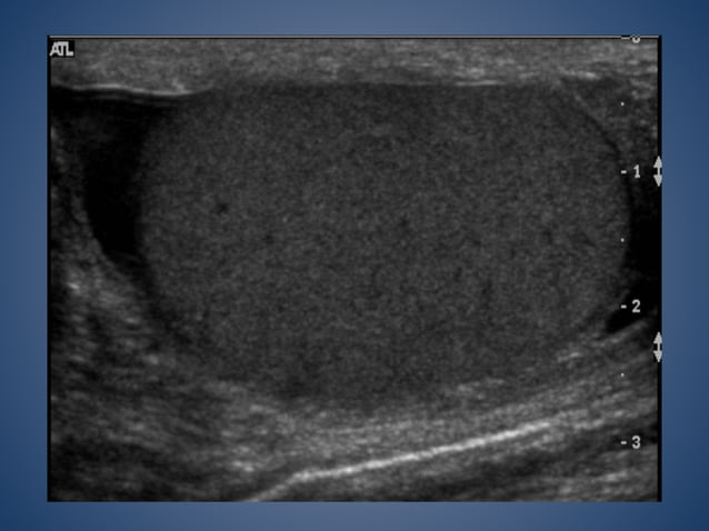 Imaging of Inguino scrotal region | PPTX