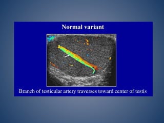 Imaging of Inguino scrotal region | PPTX