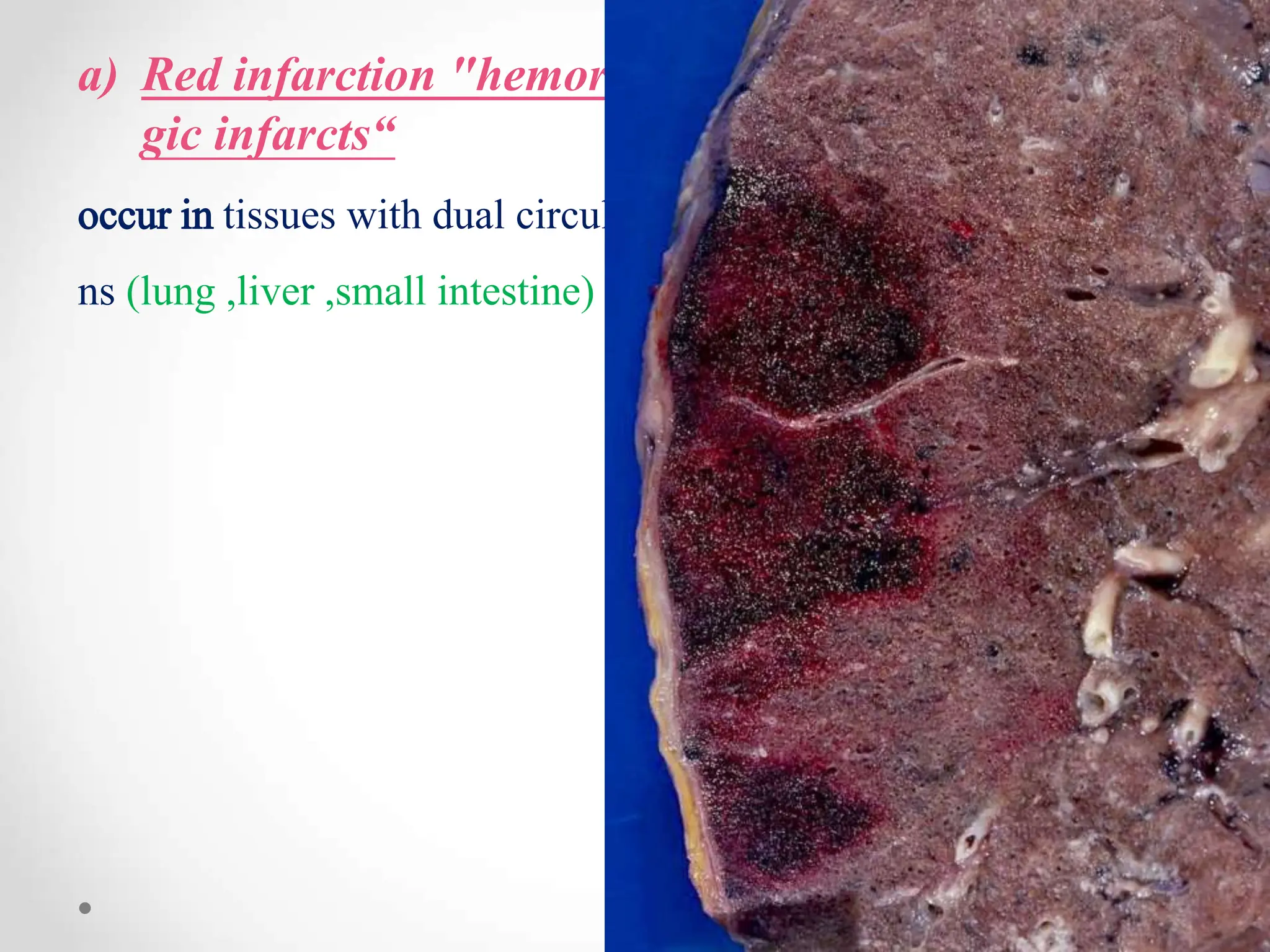 5 Ischemia Infarction & Gangrene in pathology.pptx