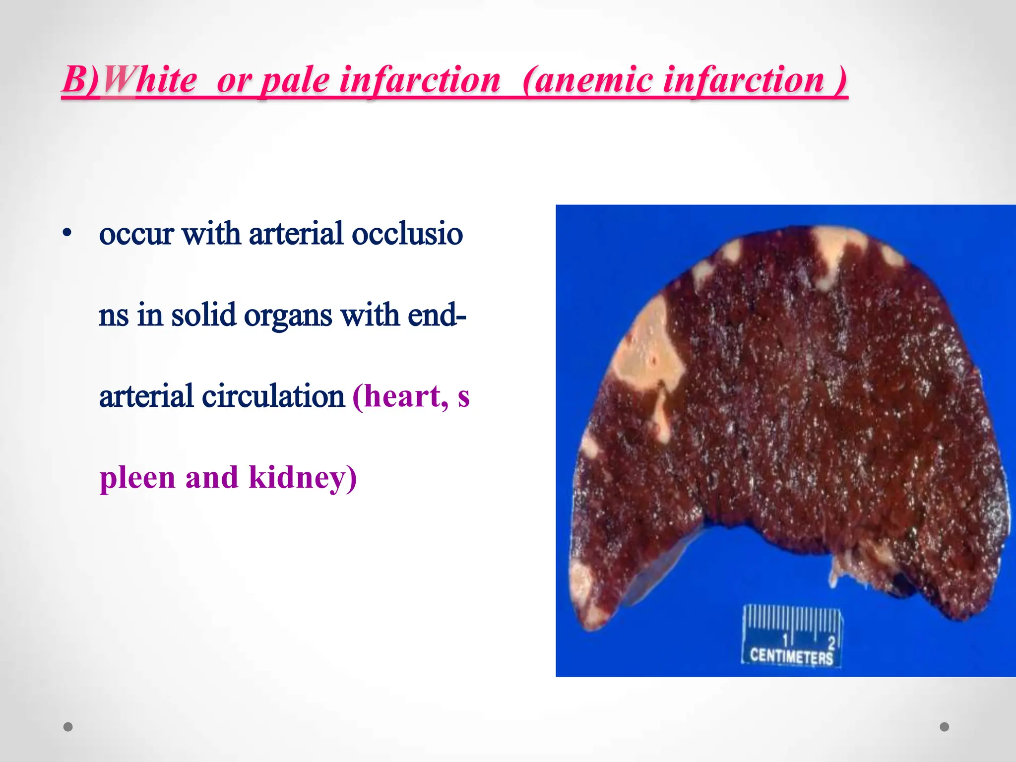 5 Ischemia Infarction & Gangrene in pathology.pptx