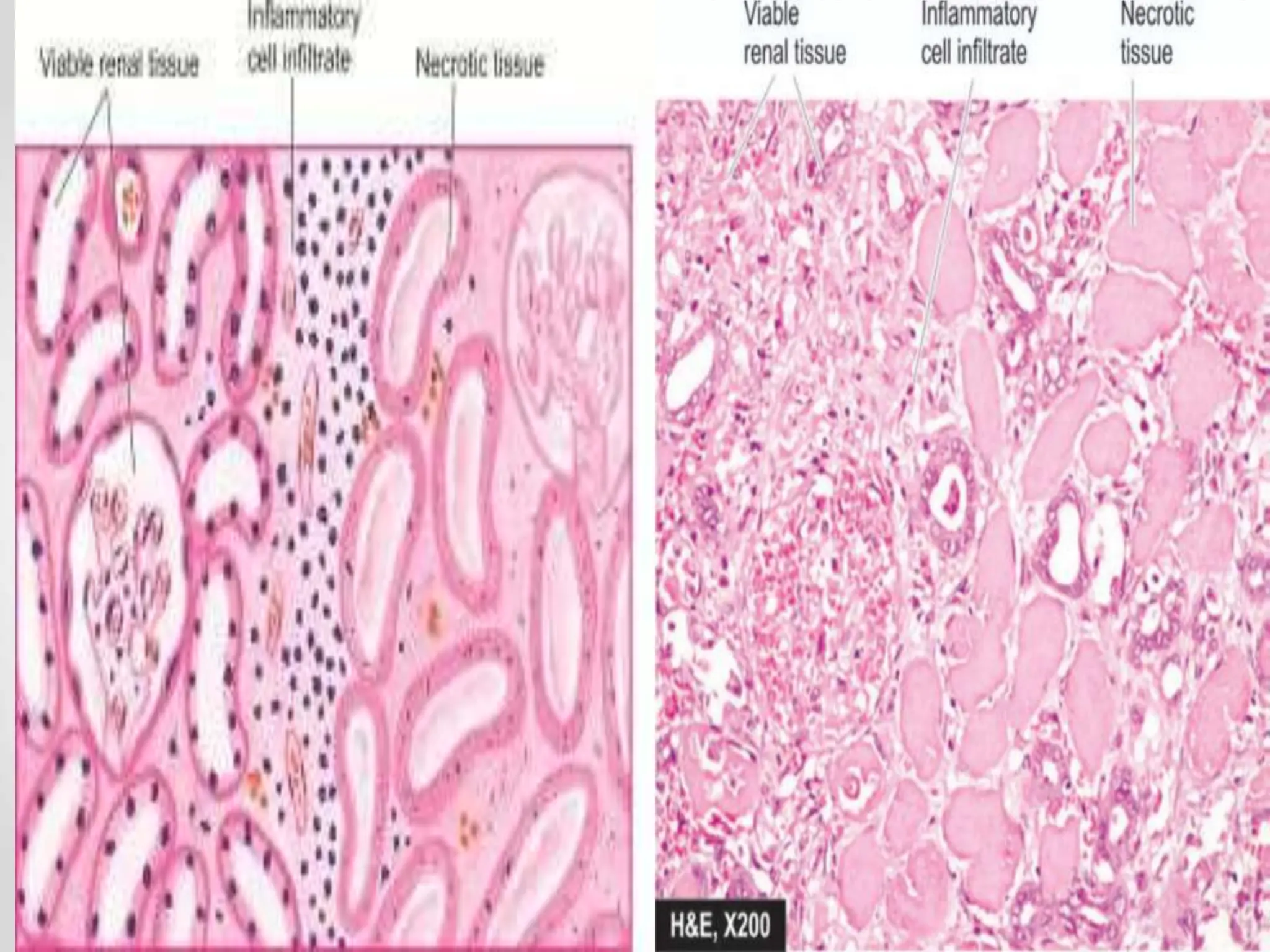 5 Ischemia Infarction & Gangrene in pathology.pptx