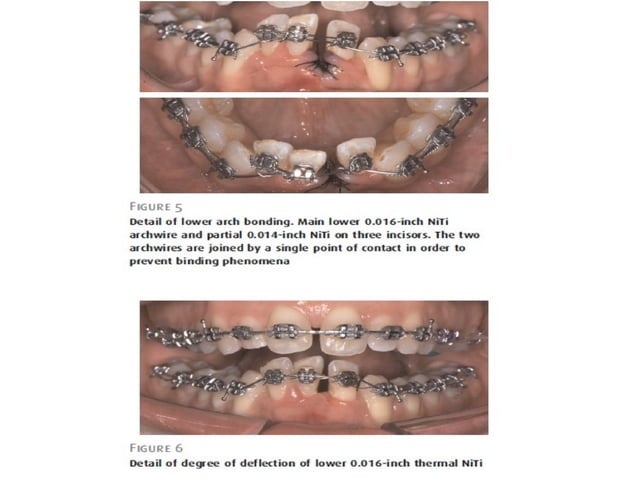 5 JC - mandibular incisor extraction .pptx
