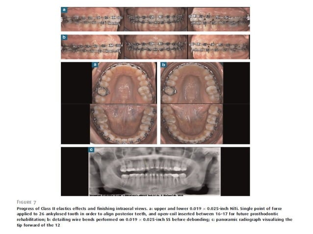 5 JC - mandibular incisor extraction .pptx