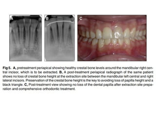 5 JC - mandibular incisor extraction and effect on whole arch | PPTX
