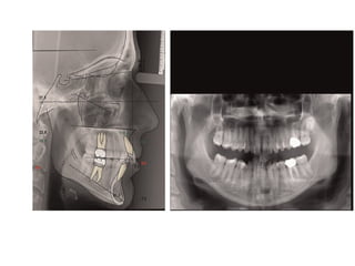 5 JC - mandibular incisor extraction and effect on whole arch | PPTX