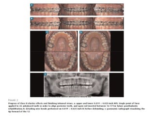 5 JC - mandibular incisor extraction and effect on whole arch | PPTX