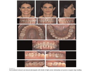 5 JC - mandibular incisor extraction and effect on whole arch | PPTX