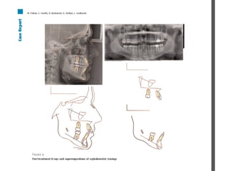 5 JC - mandibular incisor extraction and effect on whole arch | PPTX