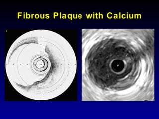 Optical coherence tomography optical biopsy with a short photonic ...