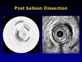 Optical coherence tomography optical biopsy with a short photonic ...