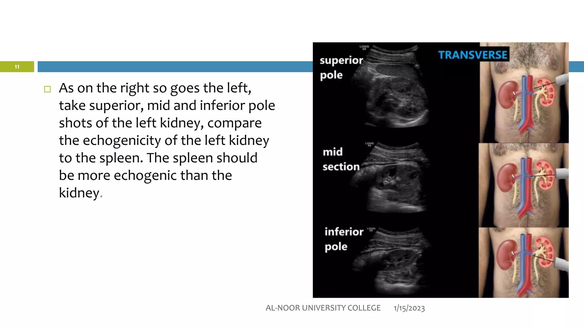ultrasound of kidneys | PPTX