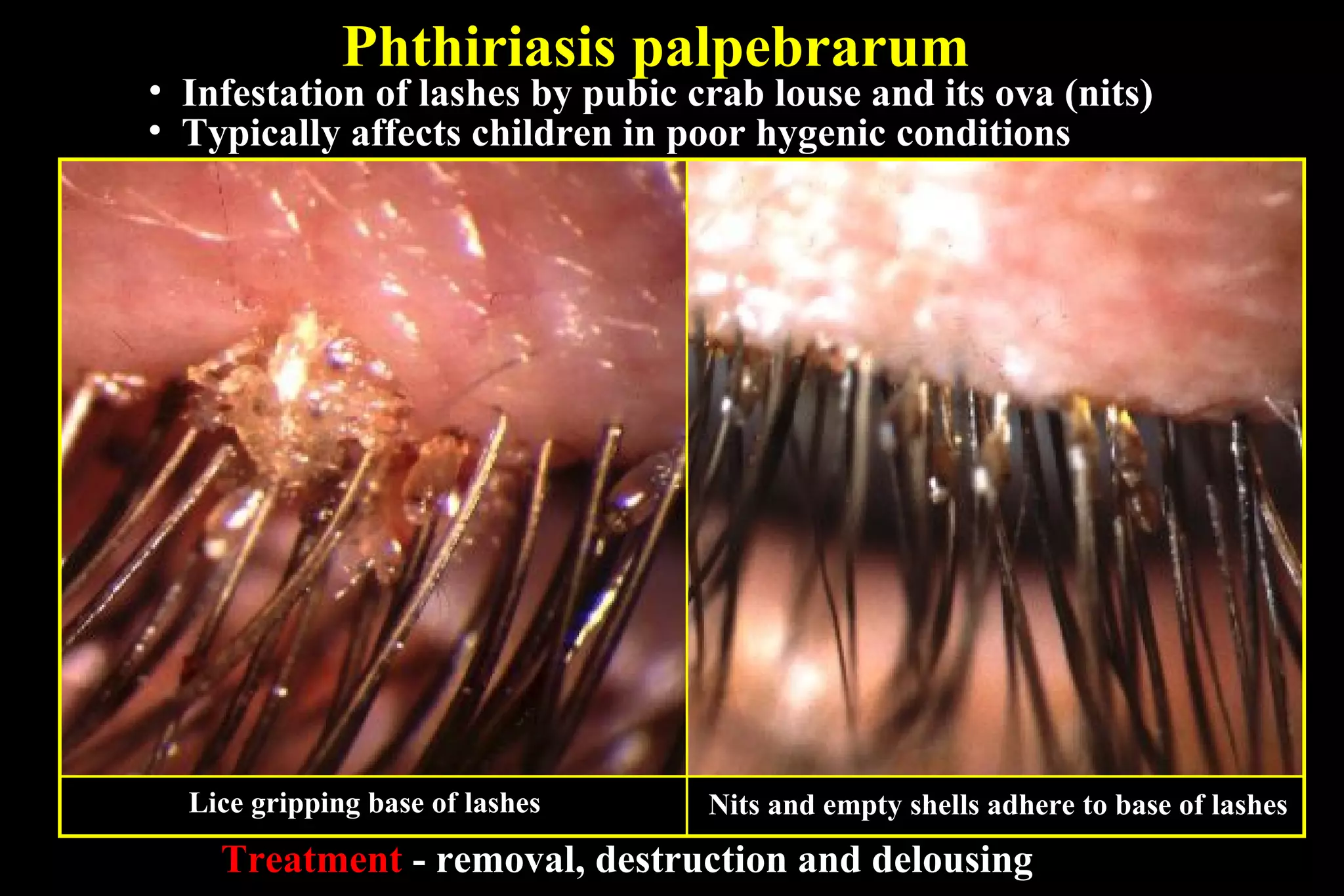 01 disorders of lashes | PPT