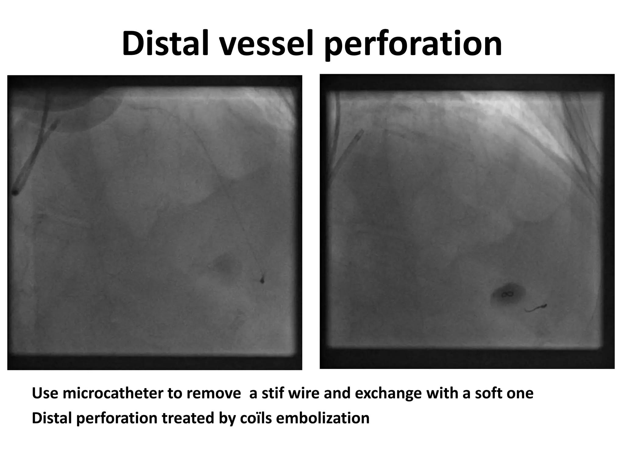 5 most important things you can do wrong in the antegrade approach ...