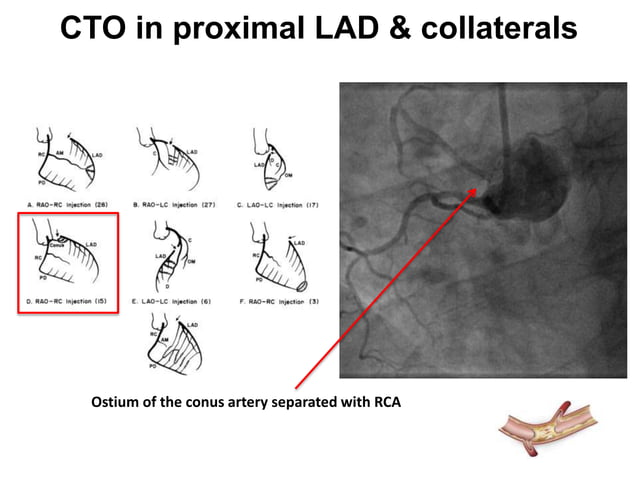 5 most important things you can do wrong in the antegrade approach | PPT
