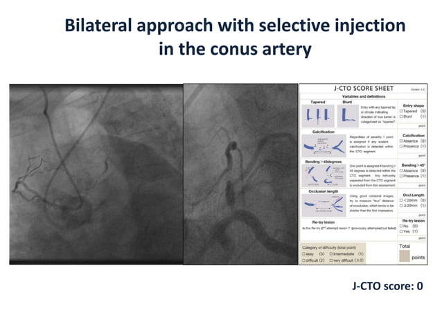 5 most important things you can do wrong in the antegrade approach | PPT