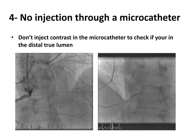 5 most important things you can do wrong in the antegrade approach | PPT