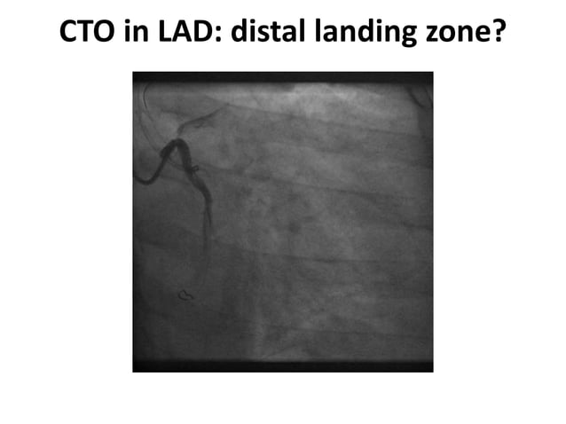 5 most important things you can do wrong in the antegrade approach | PPT