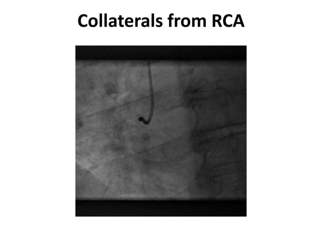 5 most important things you can do wrong in the antegrade approach | PPT