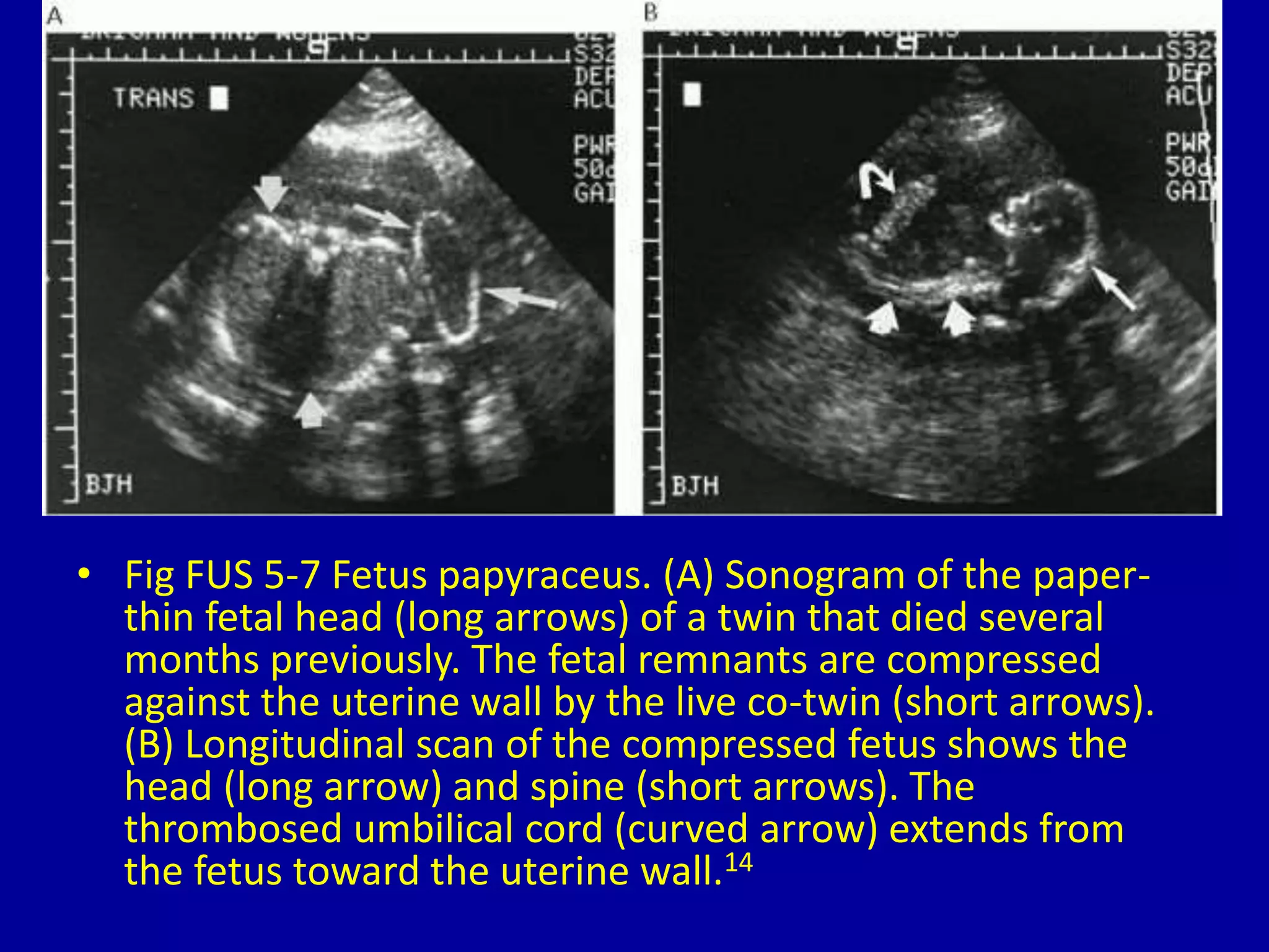 5 multiple gestations | PPTX