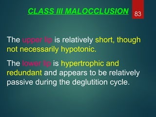 Muscles,Malformation And Malocclusion.ppt