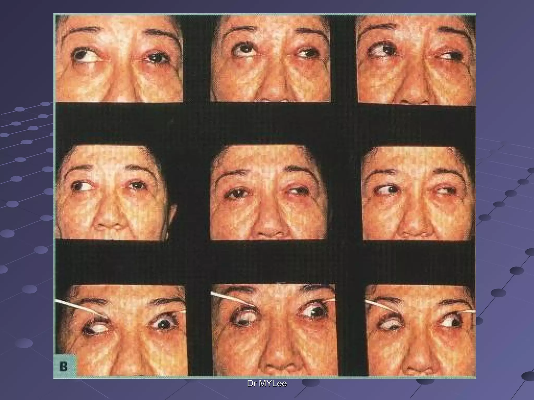Neuro-ophthalmology | PPT