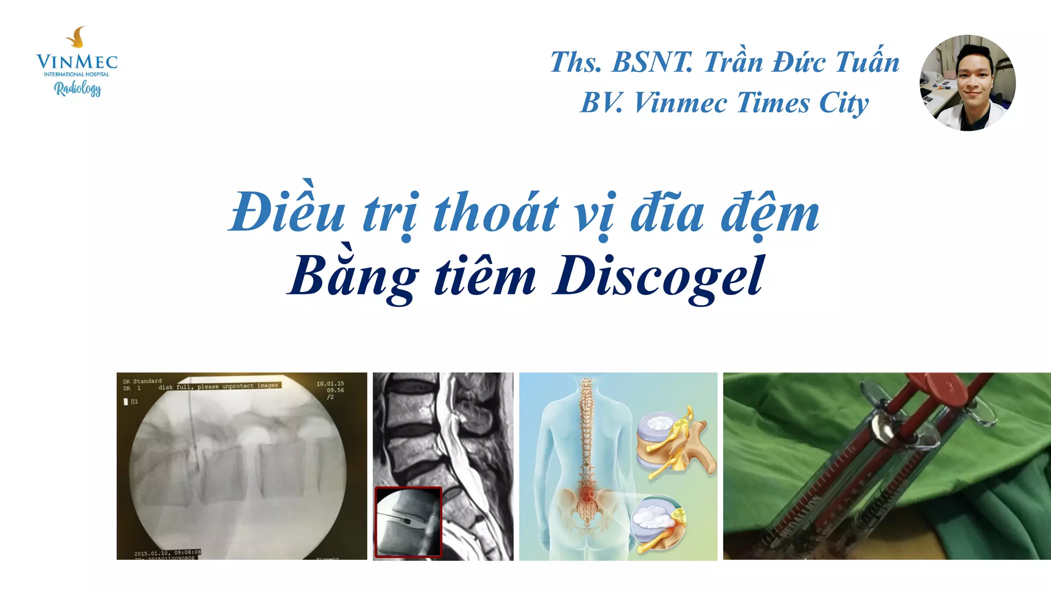 Tiêm Discogel điều trị thoát vị đĩa đệm | PDF