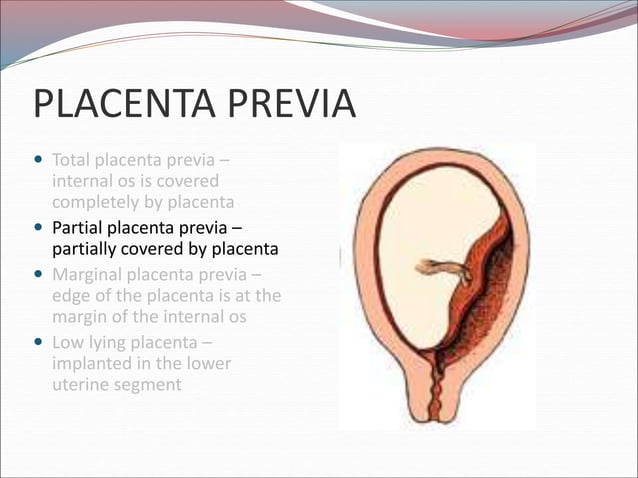 Obstetric Hemorrhage.ppt | Pregnancy | Reproductive Health