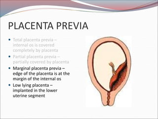 Obstetric Hemorrhage.ppt