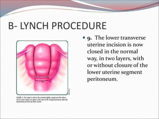 Obstetric Hemorrhage.ppt