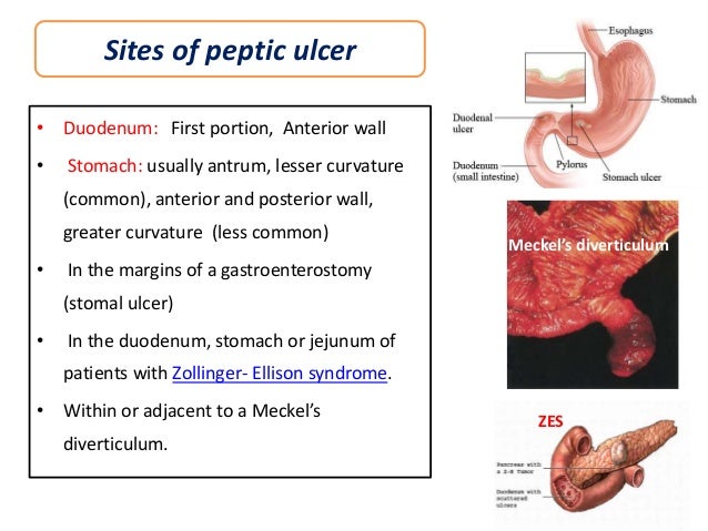Peptic ulcer